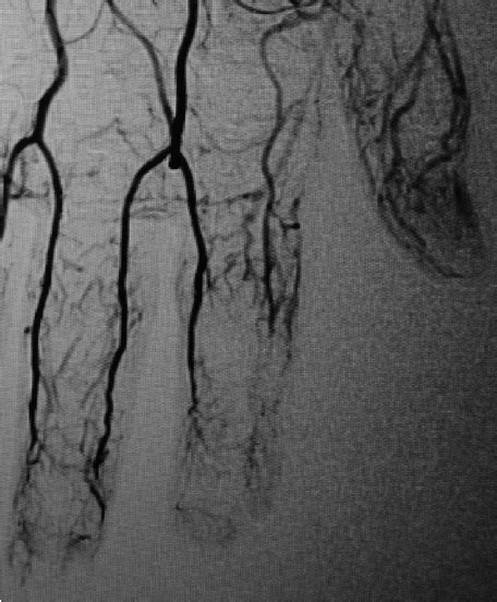 Upper Extremity Arteriogram Showing Multilevel Occlusions Of The Proper
