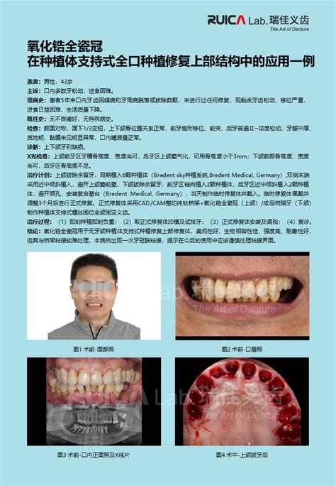 氧化锆全瓷冠在种植体支持式全口种植修复上部结构中的应用一例 瑞佳义齿