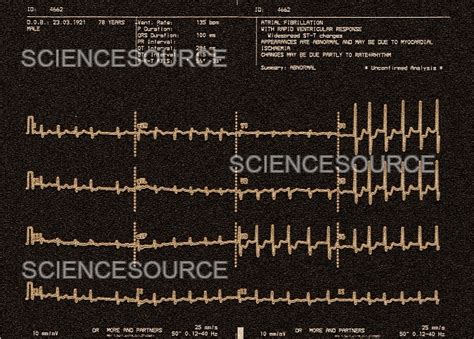 Heart Disease Stock Image Science Source Images