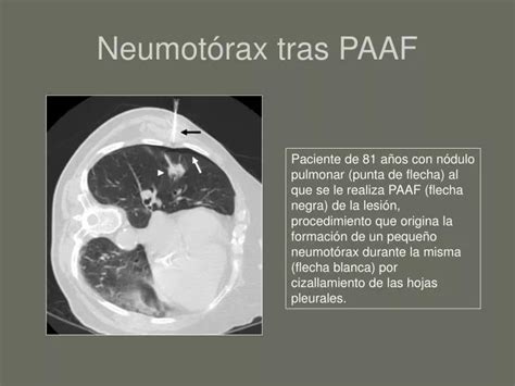 PPT Neumotórax tras PAAF PowerPoint Presentation free download ID