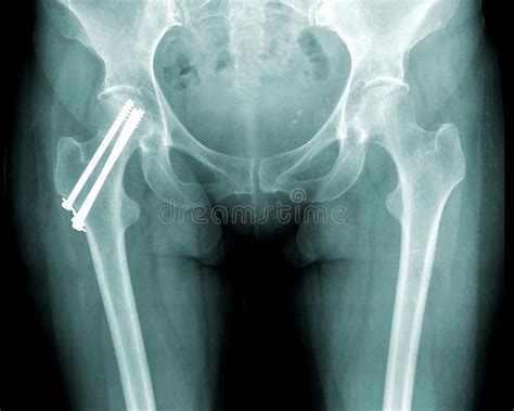 Rayon X Des Endoprostheses De Gratte Cul Photo Stock Image Du Rayons