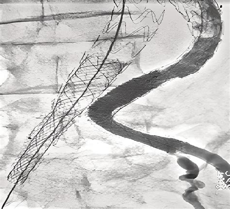 Arteriography After Endovascular Repair Of Endoleak At The Left Side