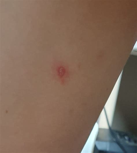 피부에 물집같은게 잡혔어요 뭘까요 ㅠ 지식in