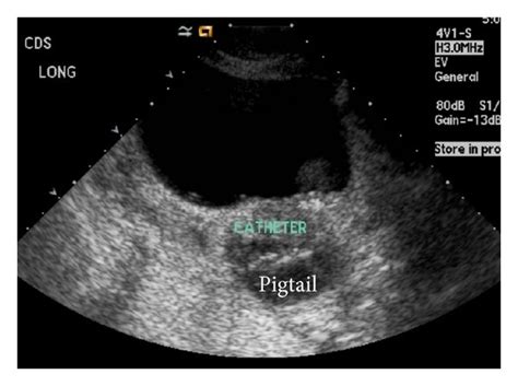 A Transvaginal Ultrasound Shows A Small Collection In The