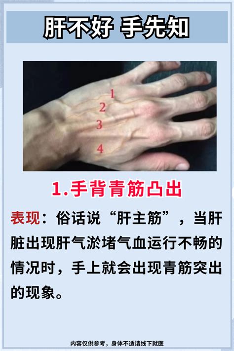 肝好不好，看手上有没有这六个信号，就知道 哔哩哔哩