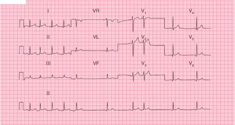 Ecg Case 50 Manual Of Medicine