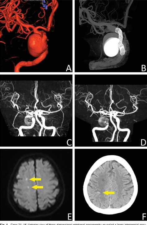 Figure 4 From A Pipeline Embolization Device For The Treatment Of Large And Giant Intracranial