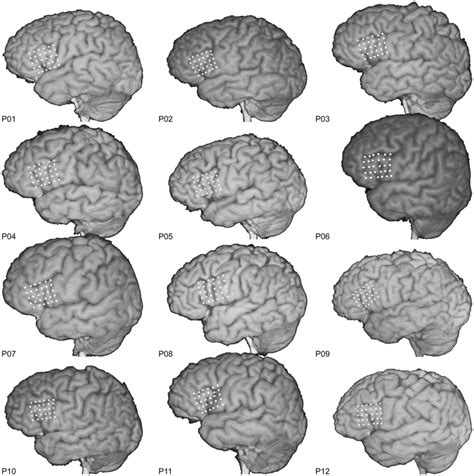 Anatomical Location Of Individual Stimulation Target Arrays The