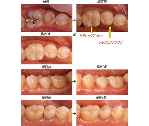 審美修復症例4 【52歳女性、セラミックアンレー、ジルコニアクラウン】－新潟の歯医者・歯科・インプラント・審美歯科なら新潟駅前歯科クリニック