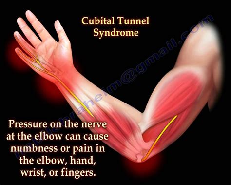 How Do You Release Ulnar Nerve Entrapment