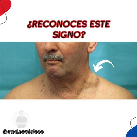 Nódulo De Virchow Víctor Rodriguez Botero Mioloco Udocz