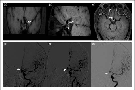 Figure 1 From High Resolution Mri In Treatment Decision Of Anterior