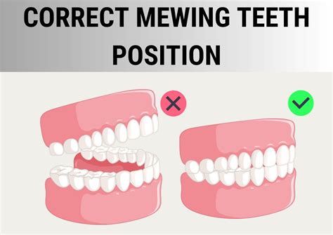 Can Mewing Straighten Teeth Before After Photos