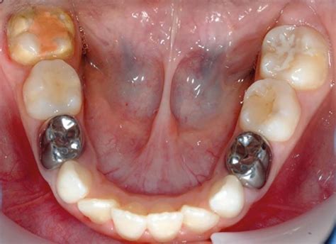 The Ultimate Guide To 6 Year Molars Symptoms Eruption Timeline And