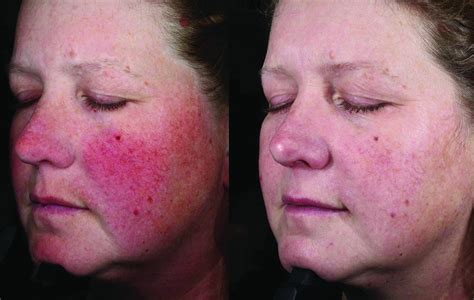 Exosomes For Anti Aging