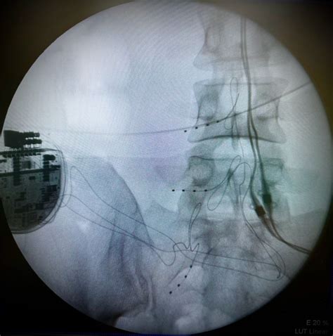 Vadim Tashlykov Md Msc Fipp On Linkedin Crps Is Valid Indication For