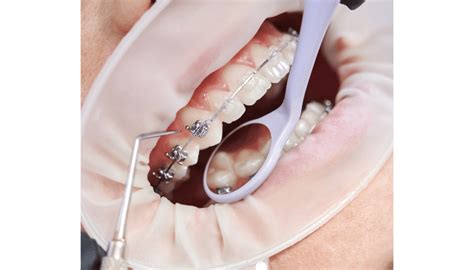 Benefits Of Braces For A Better Smile Oakville Family Dentist