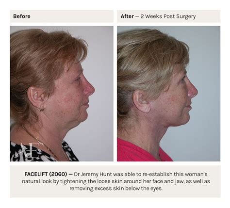 Facelift Sydney Rhytidectomy Aesthetic Edge Clinic