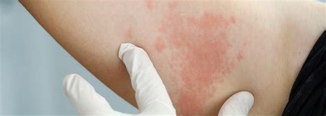 Hyperthyroidism Rash