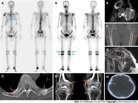 Adult Onset Hypophosphatemic Osteomalacia As A Cause Of Widespread