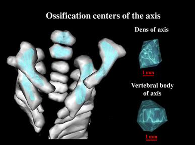 Bone Reconstruction Of Cervical Vertebrae And The Odontoid And Body