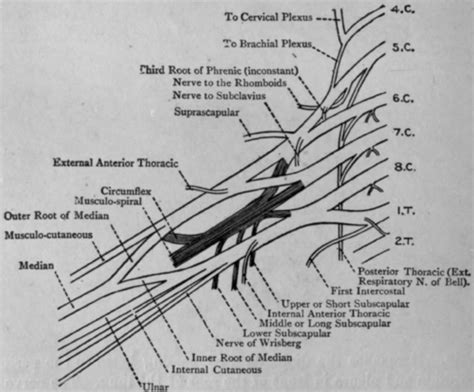 Neuritis Brachial Plexus Neuritis