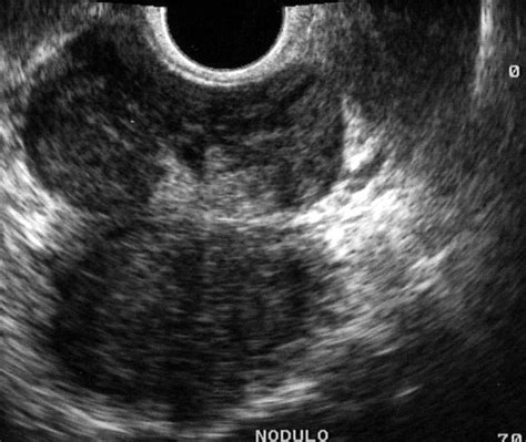 Nodulo Solido Gigante De Prostata