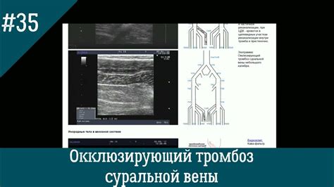 УЗИ вен Окклюзирующий тромбоз суральной вены Youtube