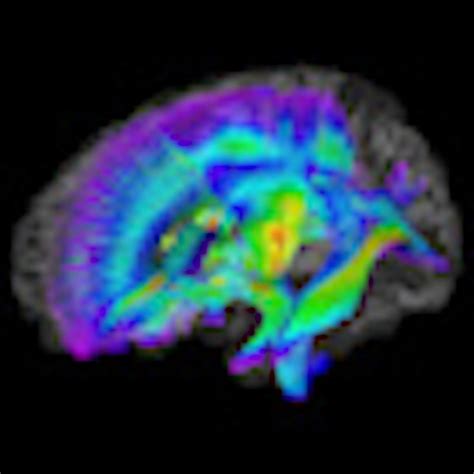 Dti Mri Shows Brain Differences In Infants Who Develop Autism Auntminnie