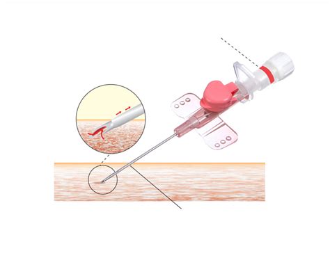 Poly Flex Adva Iv Cannula For Hospital Size Various At Best Price