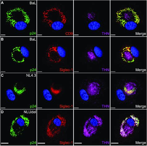 Siglec 1 Colocalizes With P24 In Vccs Of Hiv 1 Infected Mdms A Mdms Download Scientific