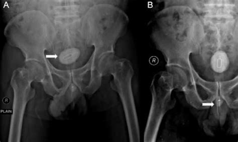 They Re Definitely Not Supposed To Go There Man Left In Agony After Sticking Sim Card