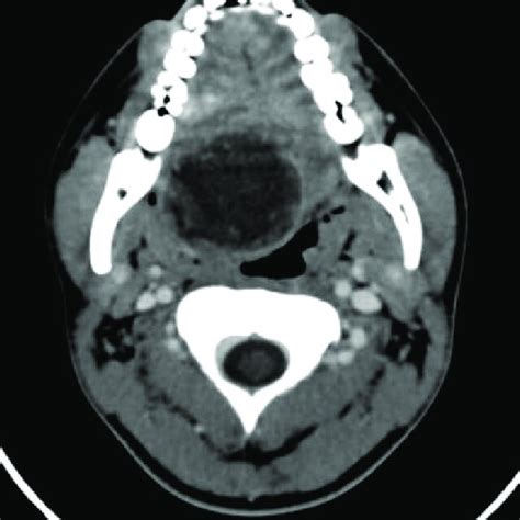 Contrast Enhanced Computed Tomography Axial Section Shows