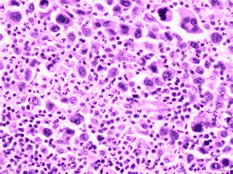 Pathology Outlines Case Of The Week 440