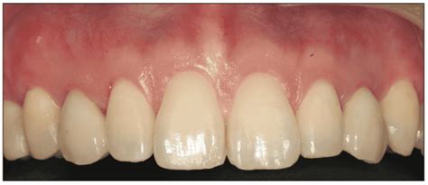 Aesthetic Improvement Of Over Retained Deciduous Canines Dentistry Today