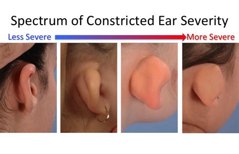 Constricted Ear — Dr Derderian — Plastic And Reconstructive Surgery