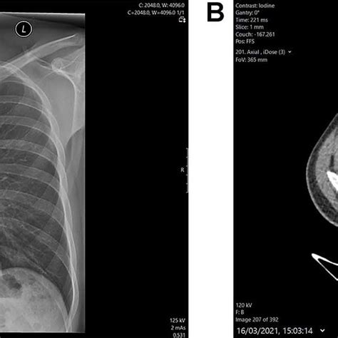 A Chest X Ray Linear Nodular Density Right Upper Lobe B Ct Thorax