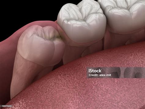 건강 한 치아와 함께 중앙 Impaction 사랑니 의학적으로 정확한 치아 3d 그림 이빨에 대한 스톡 사진 및 기타 이미지