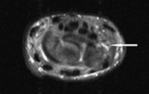 Comparative Radiological Diagnostics Of Acute Triangular Fibrocartilage Complex Injuries Pmc