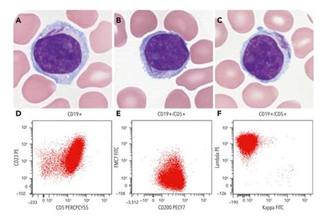 Eu Amo Hematologia Hematology Linfoblasto Lymphoblast Os