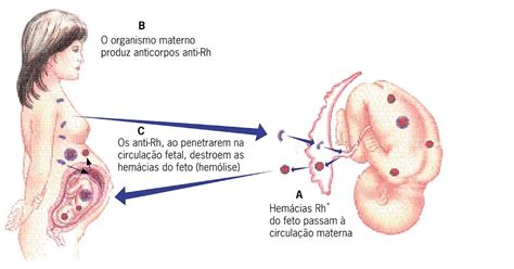 Fisio Unec Eritroblastose Fetal