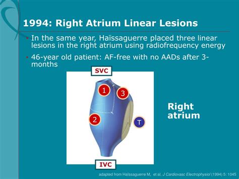 Ppt Section Iii Catheter Ablation For The Treatment Of Afib
