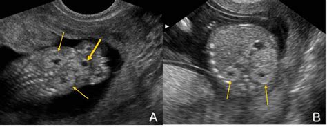 Figure 1 From Prenatal Evaluation Of Fetal Urinary Bladder And