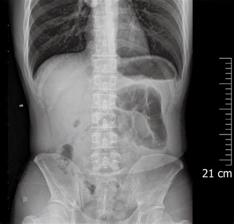 Abdominal Separation In An Adult Male Patient With Acute Abdominal Pain