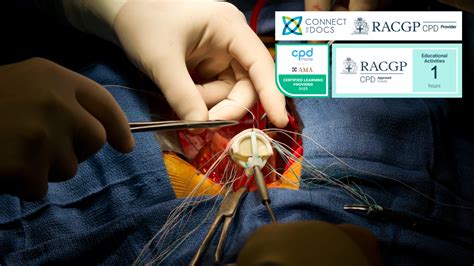 Minimally Invasive Cardiac Surgery Mics Medd Australia