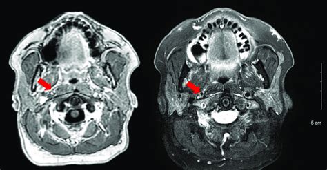 Axial T1 Postcontrast And T2 Fat Sat Displaying Reduced Caliber Of The