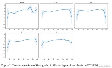 论文阅读 《unsupervised transformer based anomaly detection in ecg signals