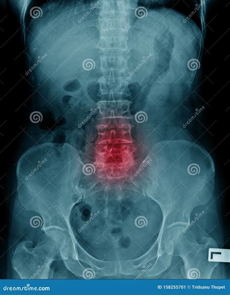 Spondylosis X Ray Image X Ray Image 158255689