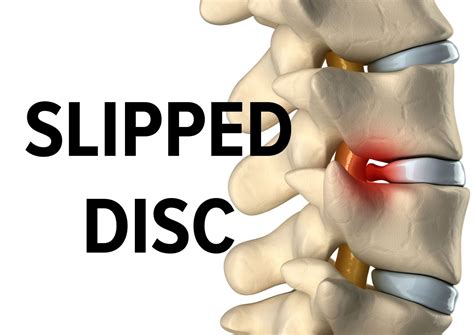 What Are The Symptoms And Causes Of Slipped Herniated Disk Hot Sex