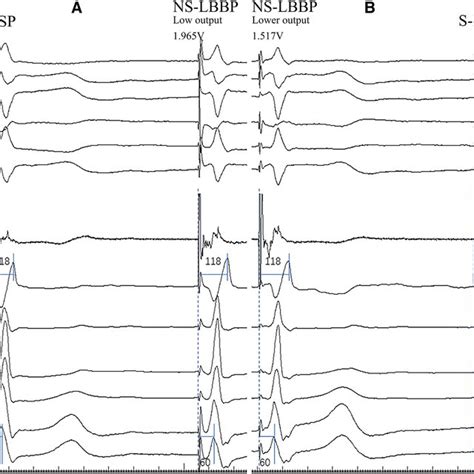 The Four Pacing Modalities Of The Implantation A Body Surface